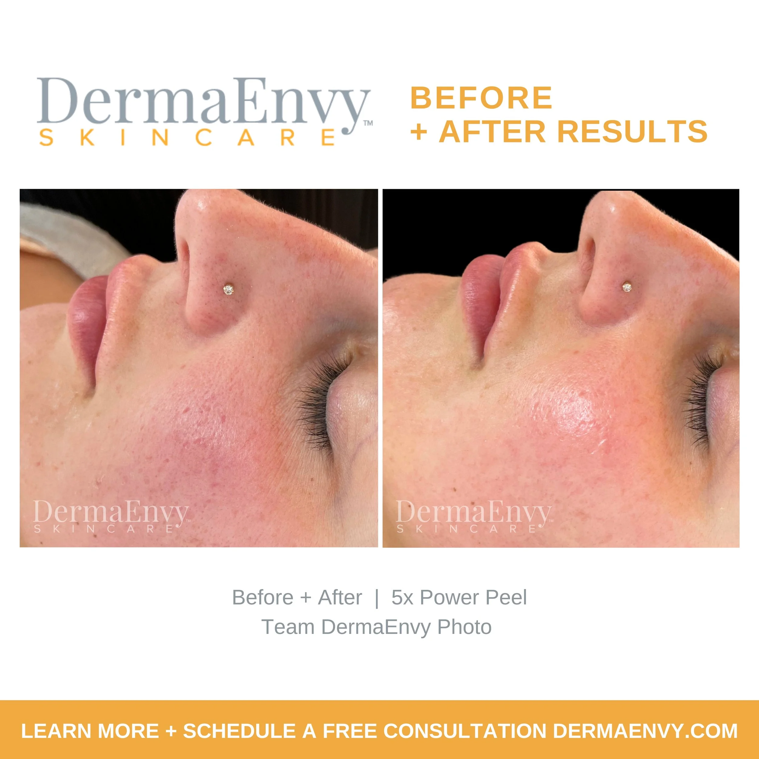 Clinical Peels | Chemical Peel Facials — DermaEnvy Skincare | Medical ...