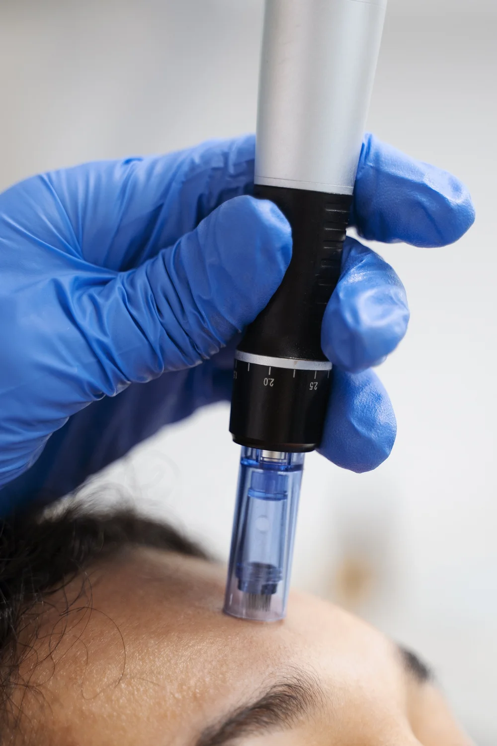 Microneedling | Microneedling near me | Book Your Treatment Today ...