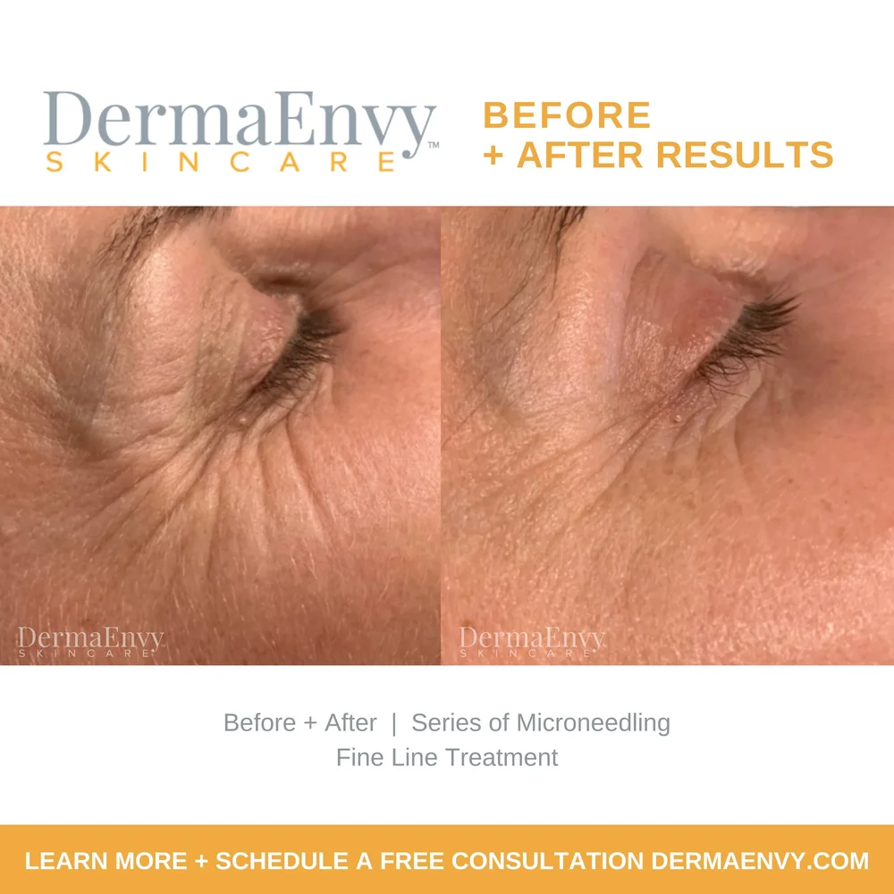 VAMP Facial Salmon DNA Microneedling Treatment | Discover Youthful Skin ...