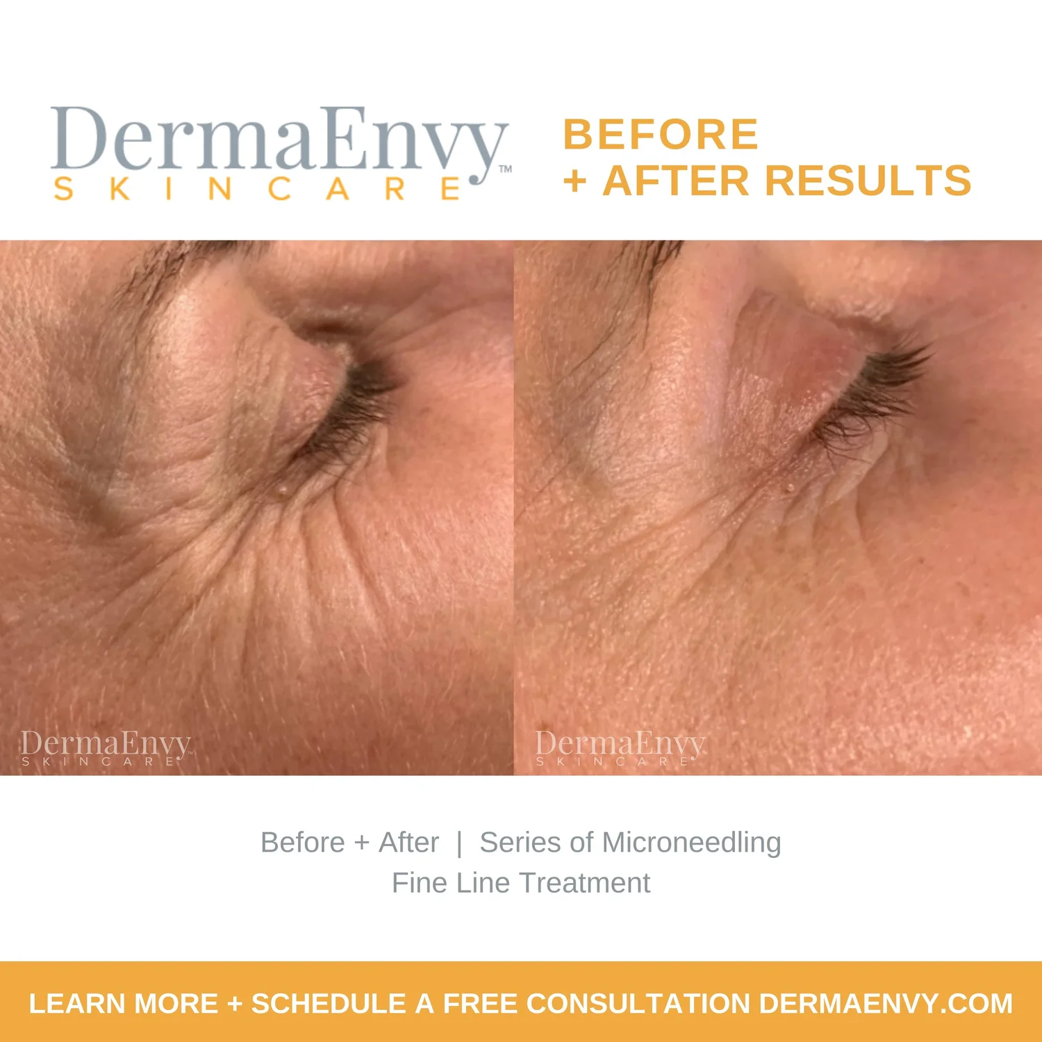 VAMP Facial Salmon DNA Microneedling Treatment | Discover Youthful Skin ...