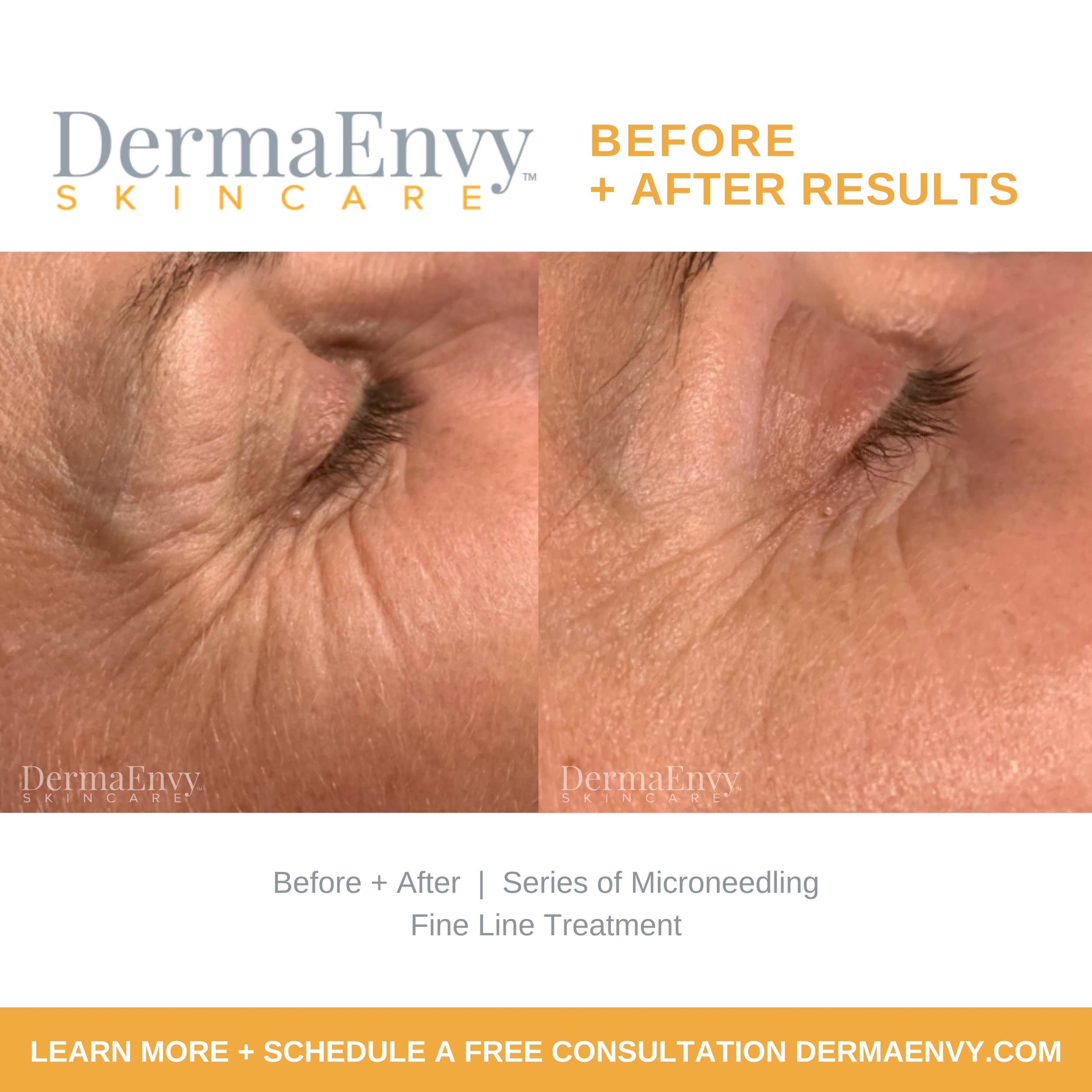 VAMP Facial Salmon DNA Microneedling Treatment | Discover Youthful Skin ...