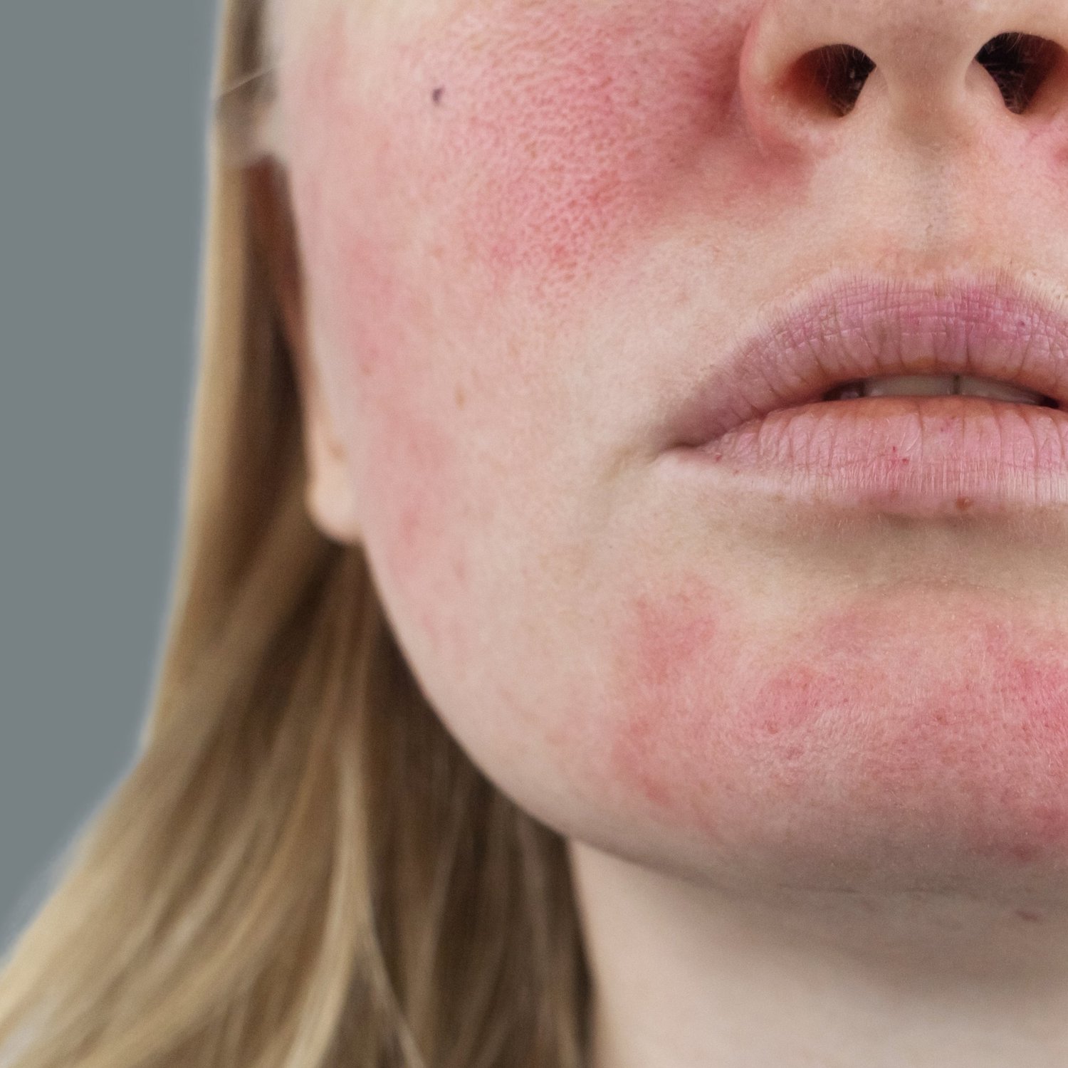Rosacea Treatment | Clear Skin Awaits — DermaEnvy Skincare | Medical ...