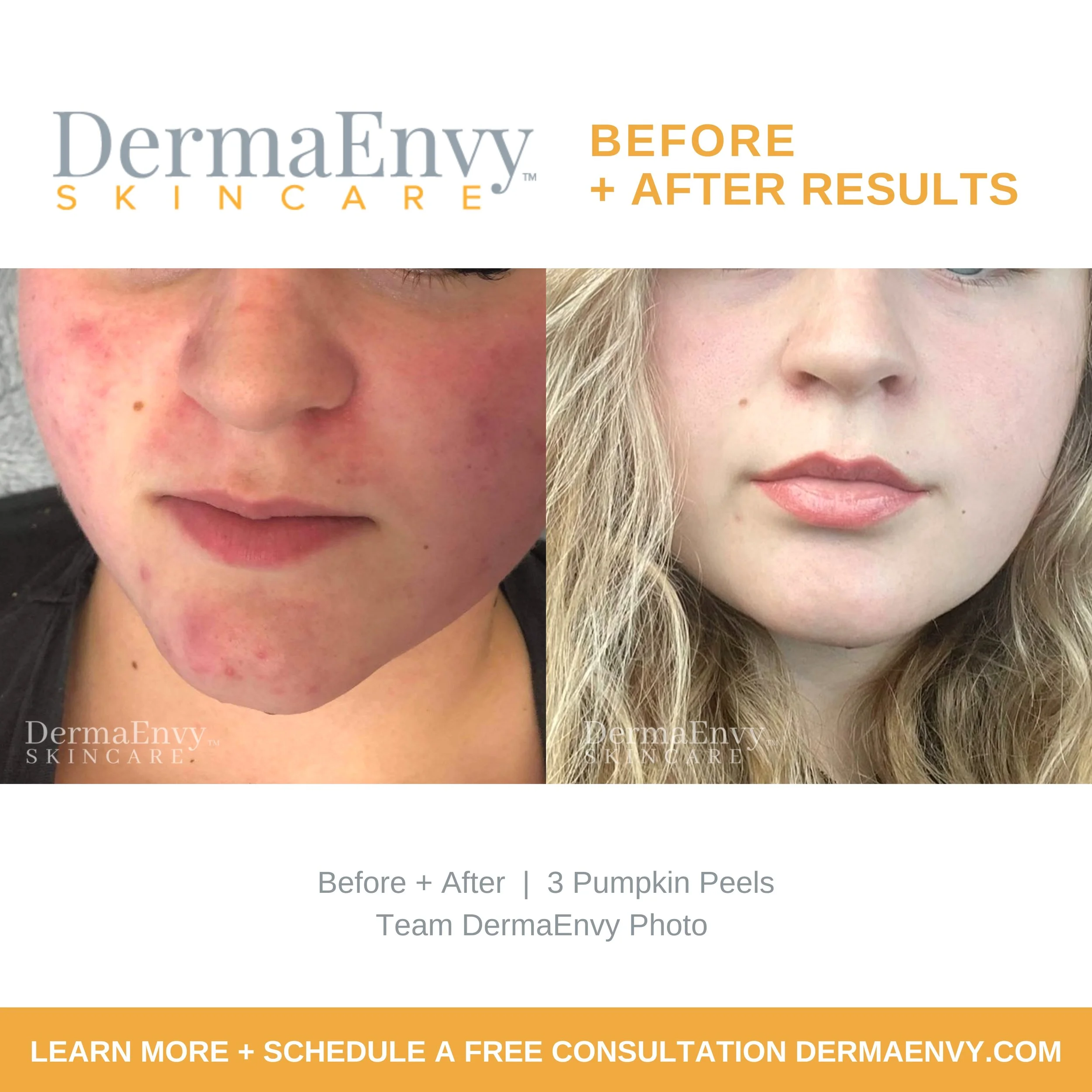 Clinical Peels | Chemical Peel Facials — DermaEnvy Skincare | Medical ...