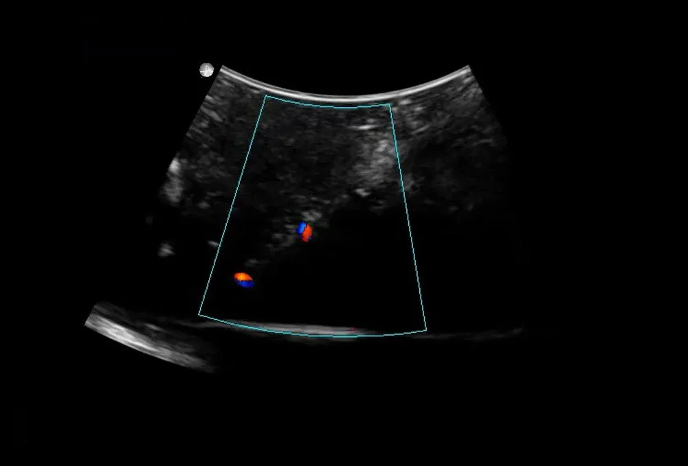 Our Technology — Active Needle