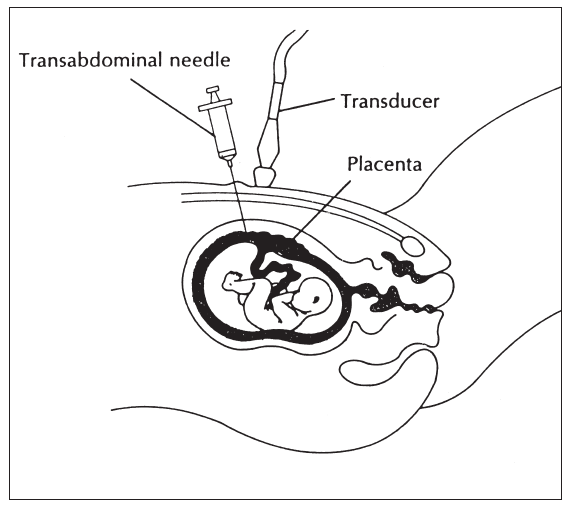 Chorionic Villus Sampling (CVS) — Melbourne Ultrasound for Women