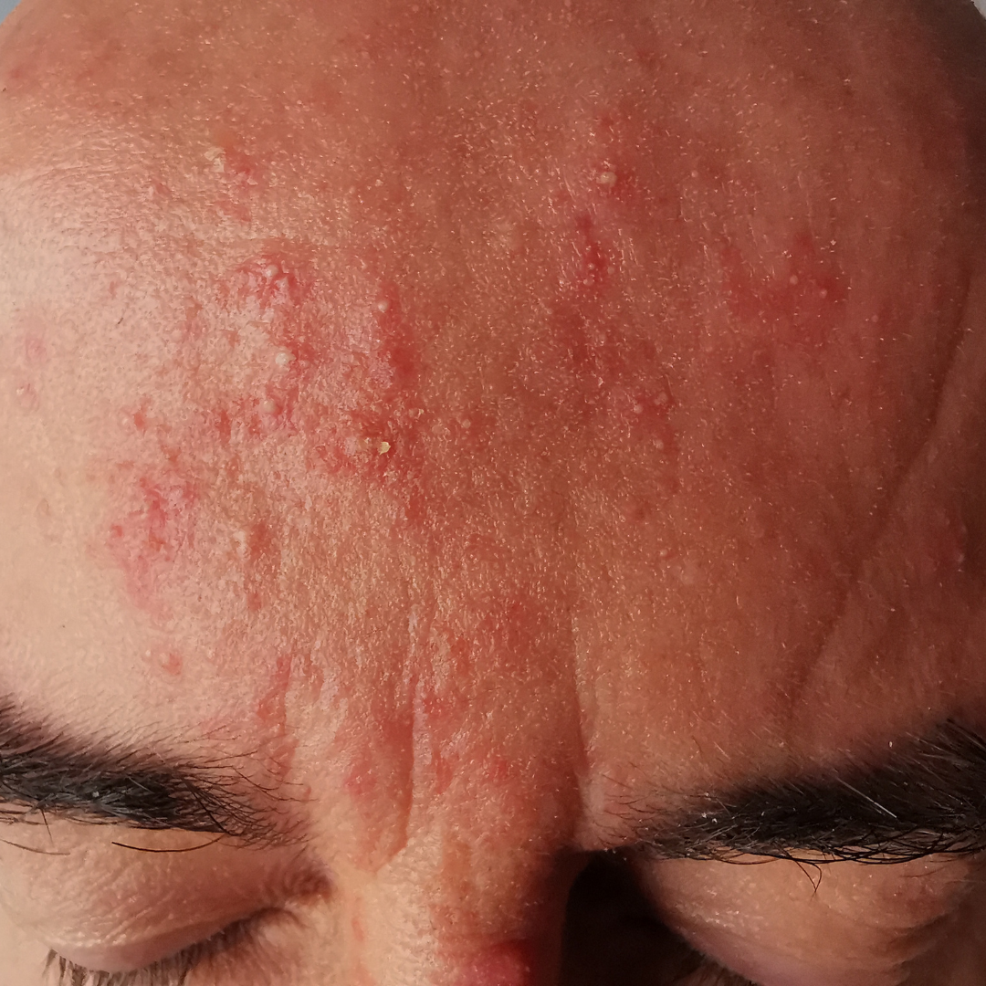 Understanding Rosacea: An Essential Guide — Bonne Vie Medical