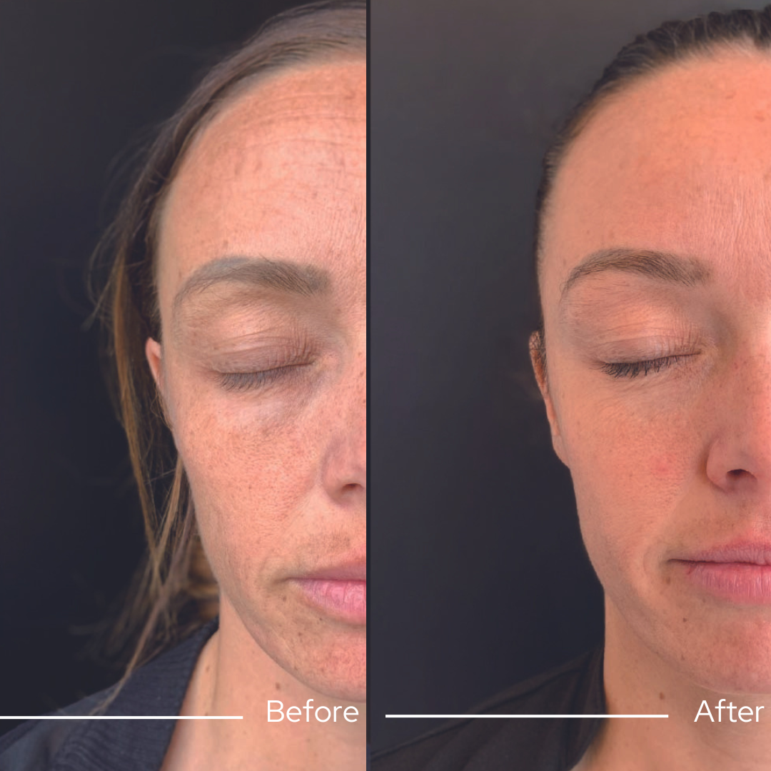 Botox, Fillers & Advanced Aesthetics: Coquitlam's Top Medispa — Bonne ...