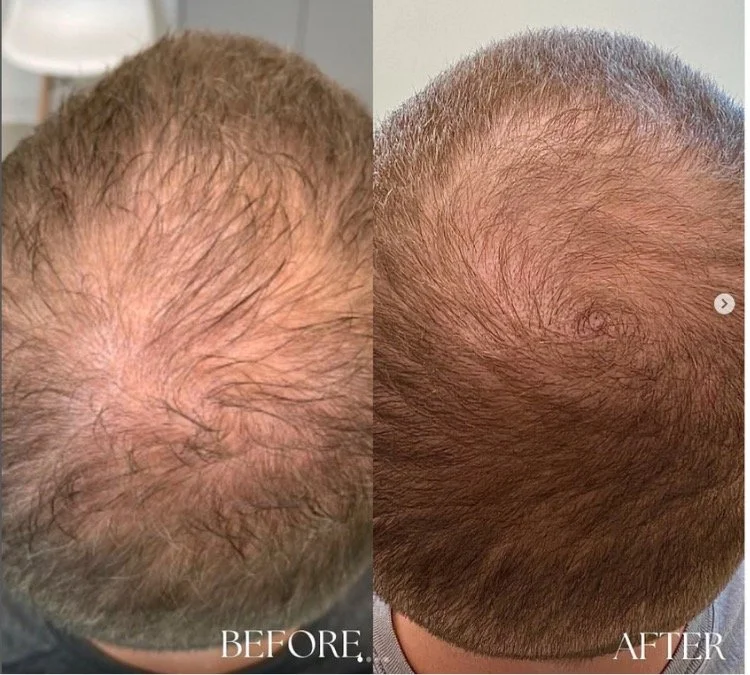 The Power of PRP Hair Restoration — Bonne Vie Medical