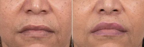 Lip Lift Before & After Photos - Cameron Brawley, MD