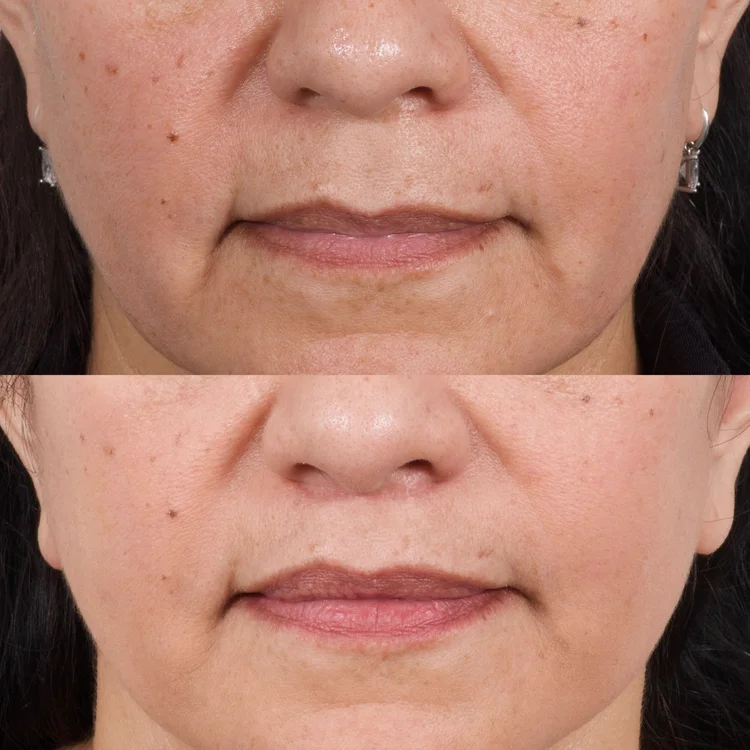 Lip Lift Before & After Photos - Cameron Brawley, MD