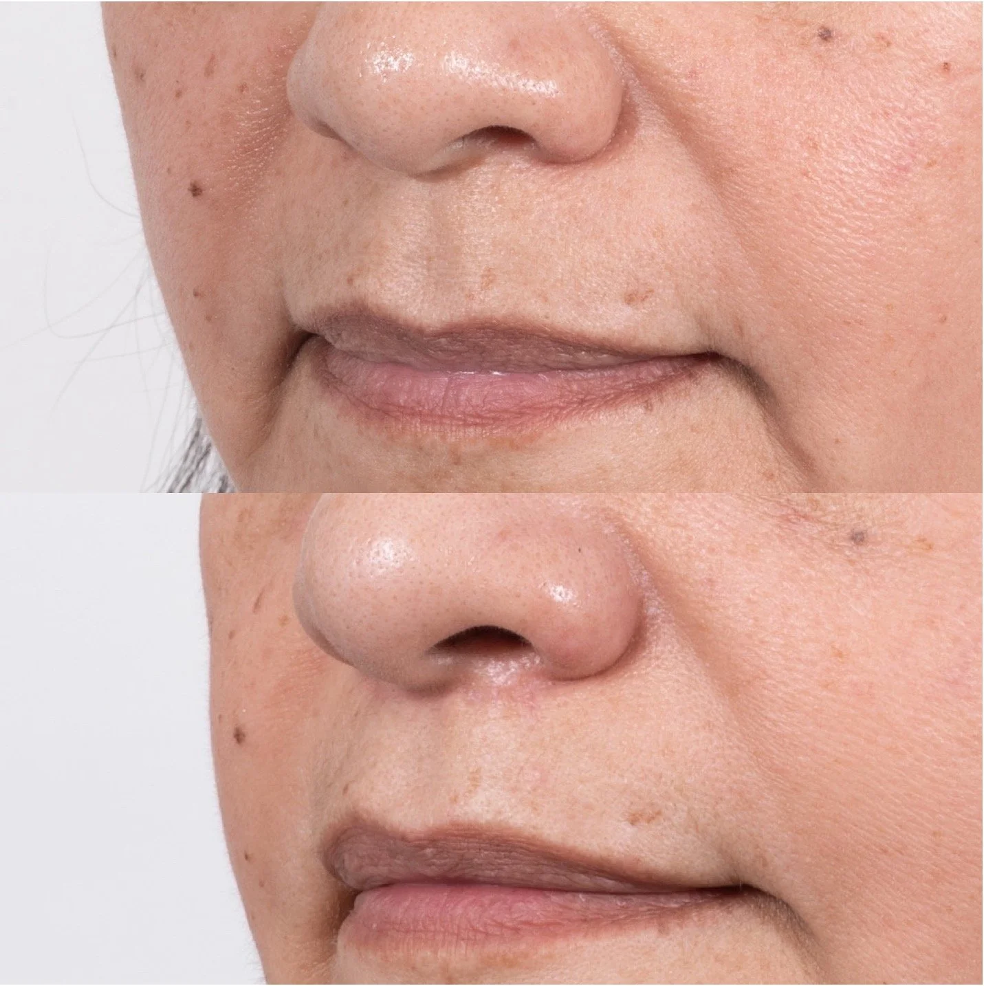 Lip Lift Before & After Photos - Cameron Brawley, MD