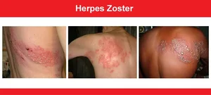 Herpes Simplex vs. Zoster Virus | Eye Infections & Differences — DR ...