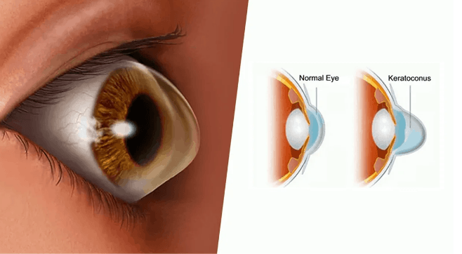 Keratoconus Disease: Causes, Symptoms, Diagnosis, and Treatment Options — DR BRENDAN CRONIN ...