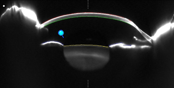 Pellucid Marginal Degeneration vs. Keratoconus | Similarities ...