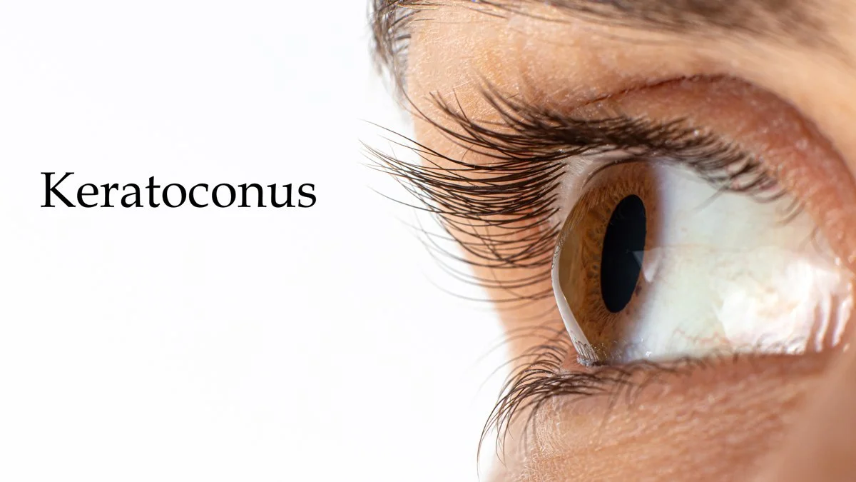 Keratoconus Disease: Causes, Symptoms, Diagnosis, and Treatment Options ...
