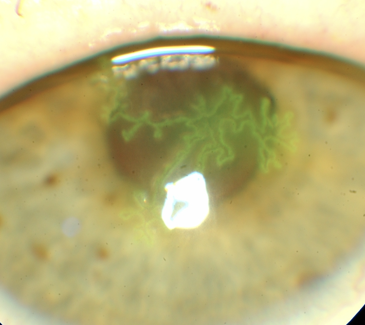 Herpes Simplex Virus vs. Herpes Zoster Virus: What's the Difference ...