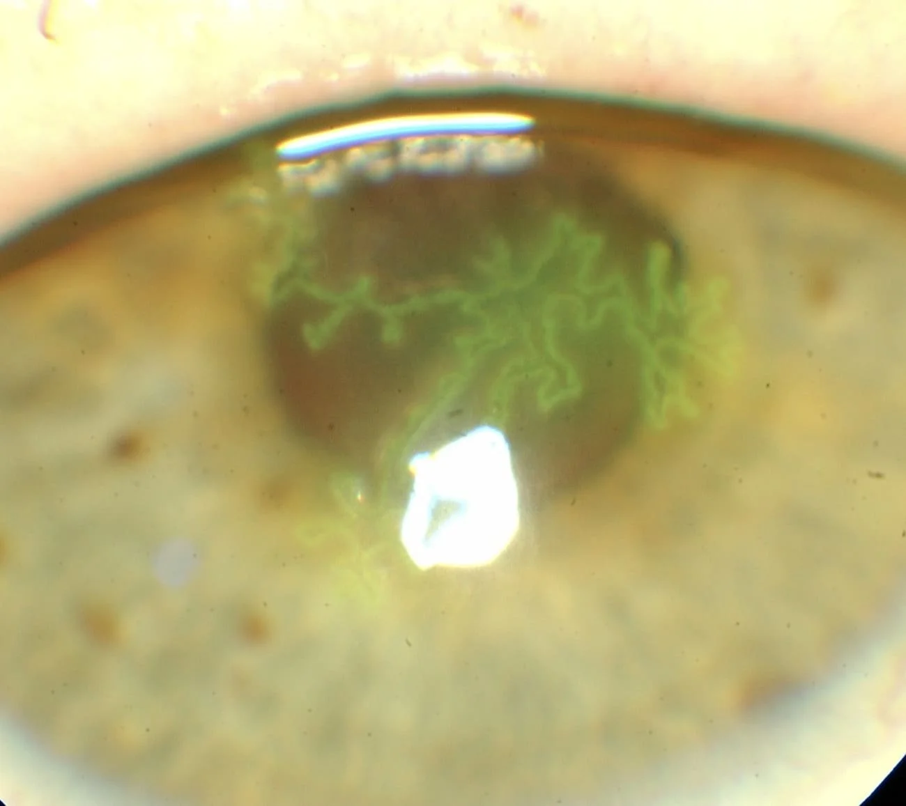 Herpes Simplex vs. Zoster Virus | Eye Infections & Differences — DR ...