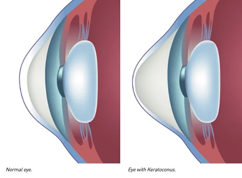 Keratoconus Disease: Causes, Symptoms, Diagnosis, and Treatment Options ...