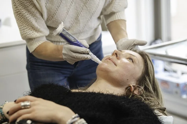 The Transformative Power of Microneedling: Get Ready for Spring and ...