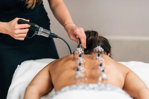 Cupping Therapy: What It Is, How It Works, and Why We Use It at ...