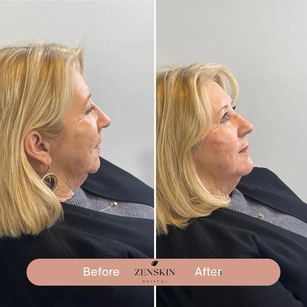 Zen Skin Bristol - Premier Med Spa in Bristol TN/VA | Expert Filler ...