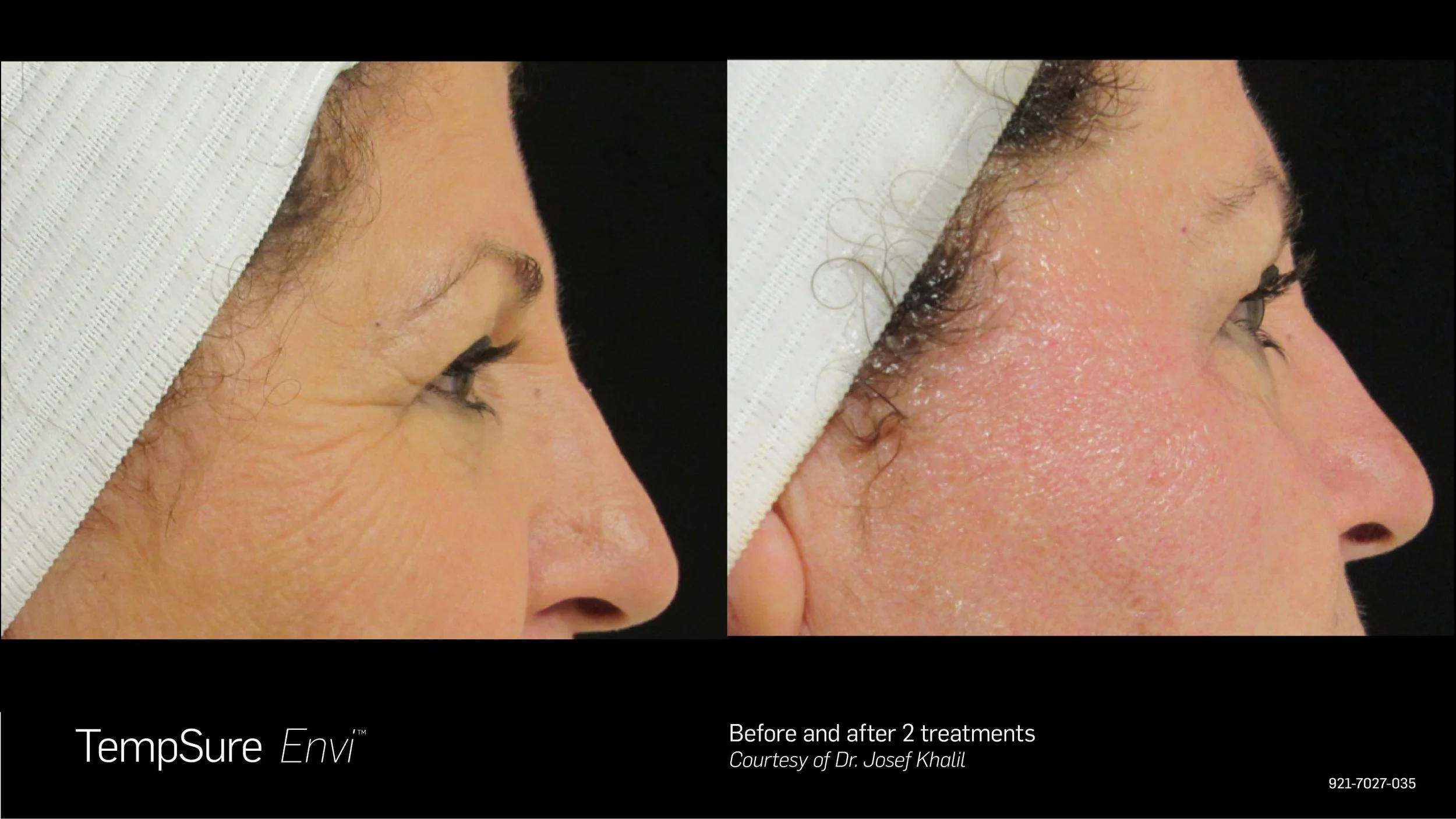 Wrinkle Treatments thourgh Tempsure Envi by Papillon MedSpa