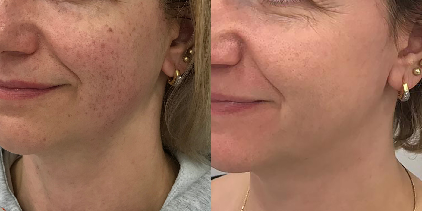 BioRePeel Treatment in Mount Prospect, IL | Papillon MedSpa