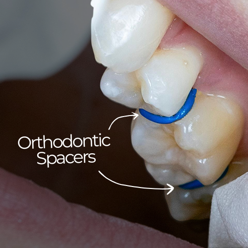 What to Eat with Spacers | Dominion Orthodontics in Mechanicsville ...