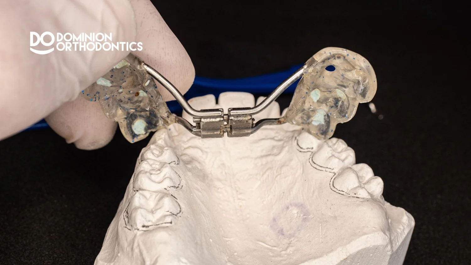 Why Early Orthodontic Treatment with Expanders Makes a Big Difference ...