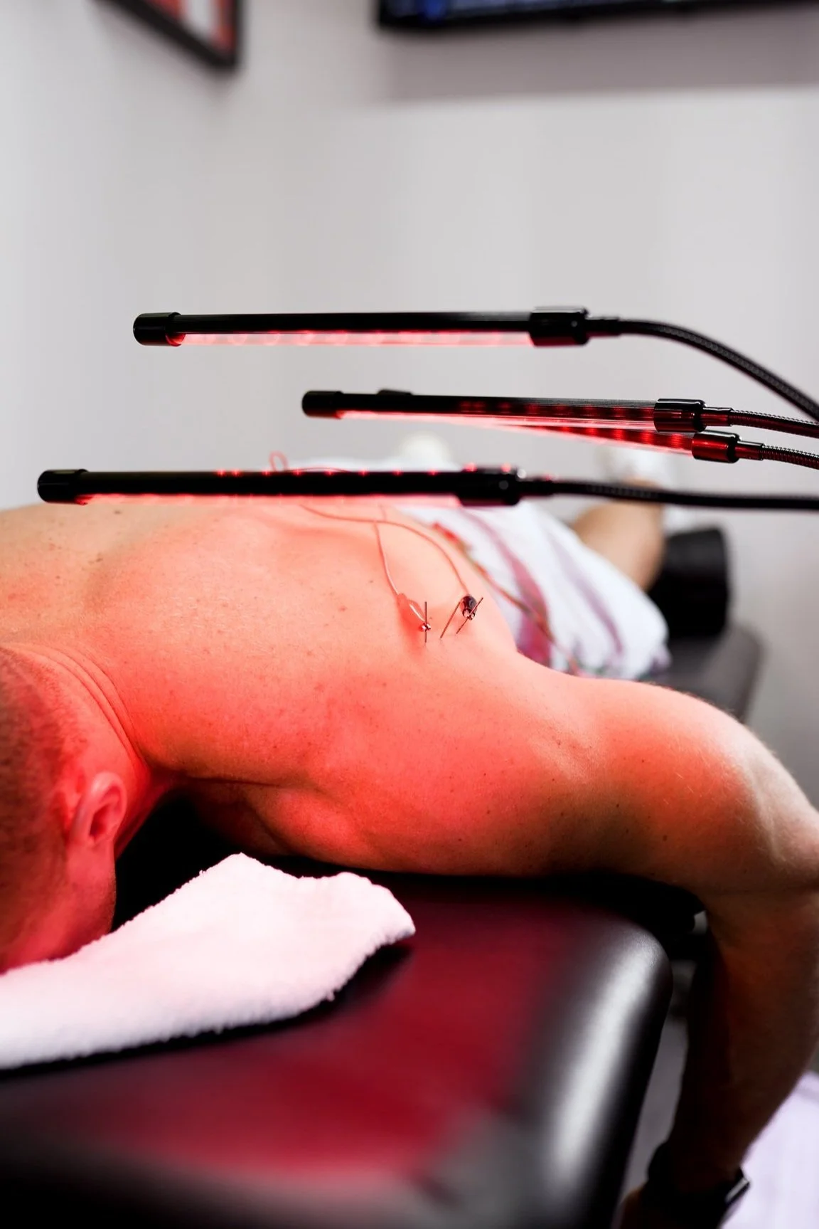 Dry Needling + Near Infrared Light Therapy — KRU Physical Therapy + Performance Lab