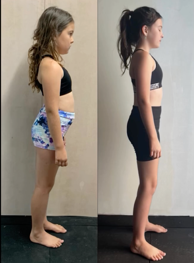 Hunchback Posture: Fix Back Pain & Build Strong Structure — Functional ...