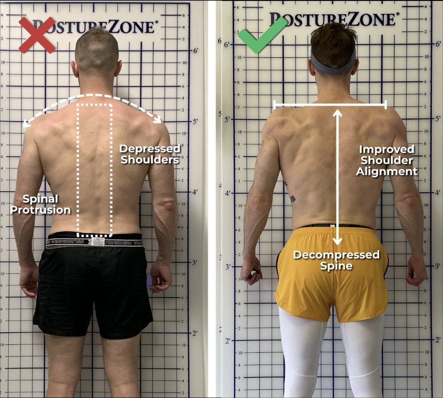Subscapularis Tendinosis Explained: Understanding the Condition Beyond ...