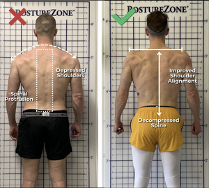 Subscapularis Tendinosis Explained: Understanding the Condition Beyond ...