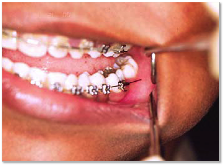 Emergency Care — Just Smile Orthodontics Braces