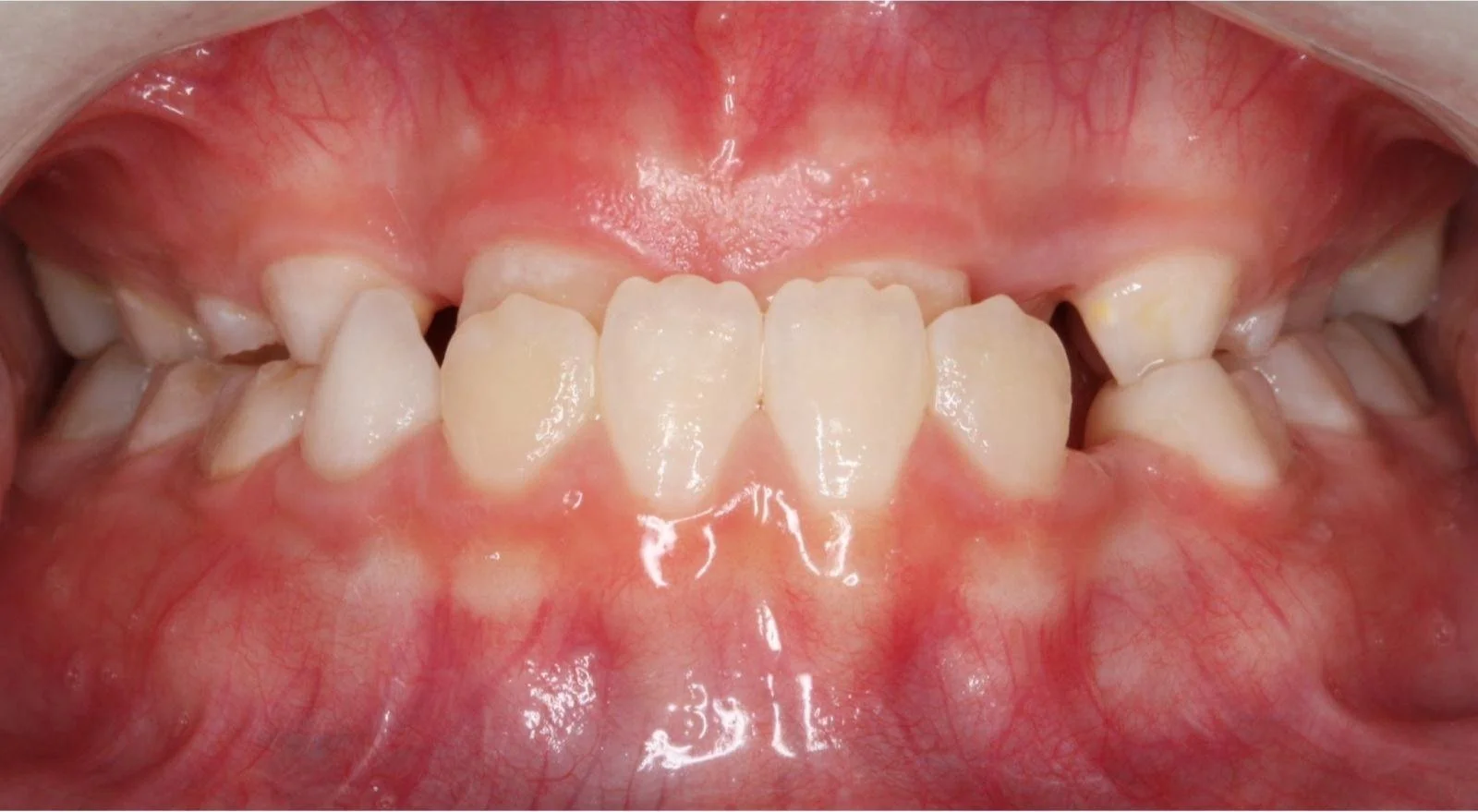 Phase 1 Braces — Just Smile Orthodontics Braces