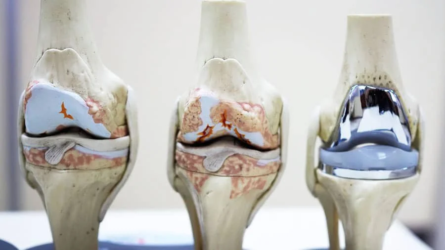 Total Knee Replacement: When, Why, and How | Your Guide to Knee Health ...