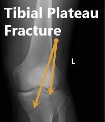Understanding Total Knee Replacement for Tibial Plateau Fracture: A ...