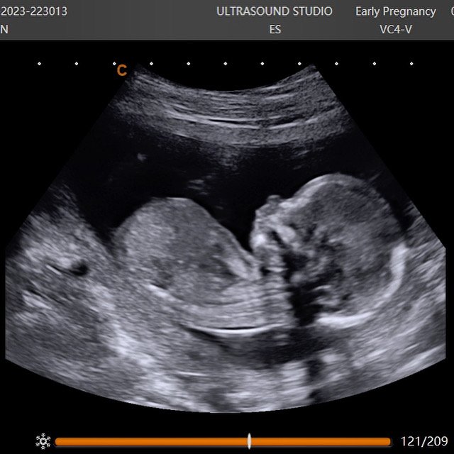 3D/4D Ultrasounds — Ultrasound Studio | 3D & 4D Pregnancy Ultrasound in ...