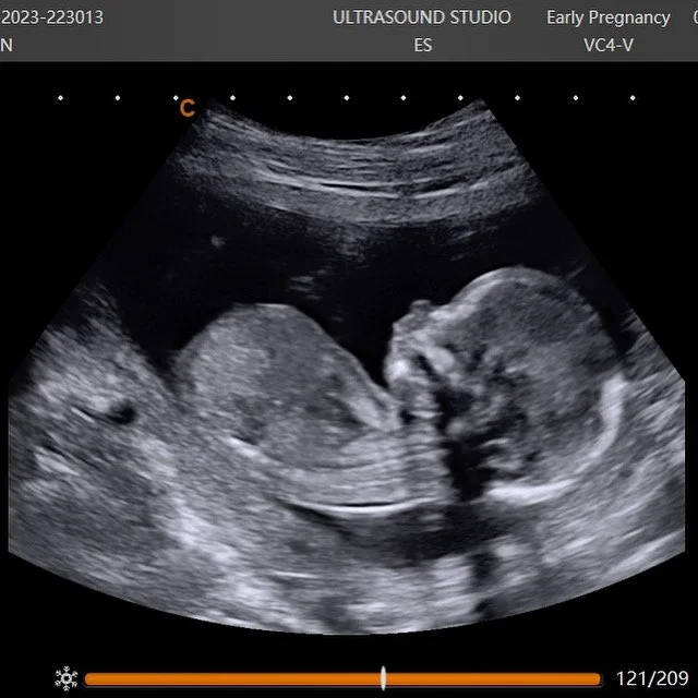 2D/3D/4D Ultrasounds — Ultrasound Studio | 3D & 4D Pregnancy Ultrasound ...