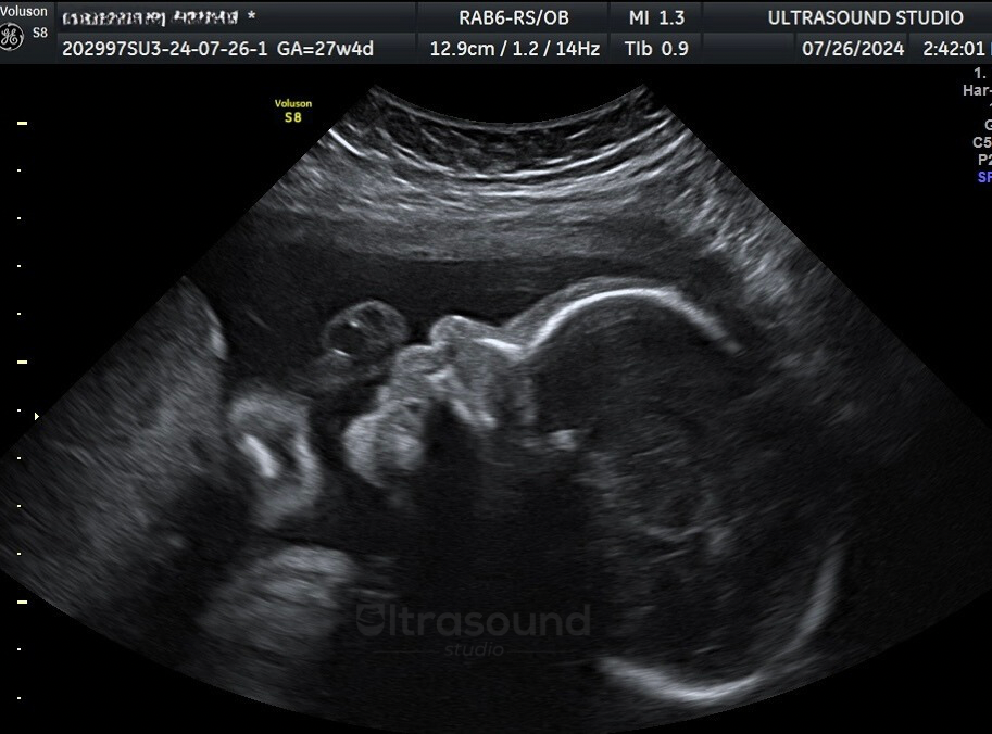 2D/3D/4D Ultrasounds — Ultrasound Studio | 3D & 4D Pregnancy Ultrasound ...