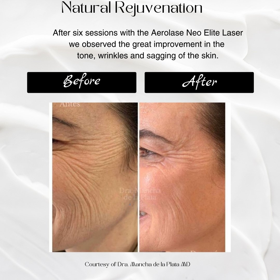 The only House-call Aerolase Neo Elite Medical Laser Service Provider ...