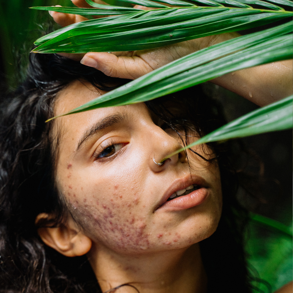 Is Your Gut the Real Culprit Behind Cystic Acne? — Dr. McKenzy Brewer, DC