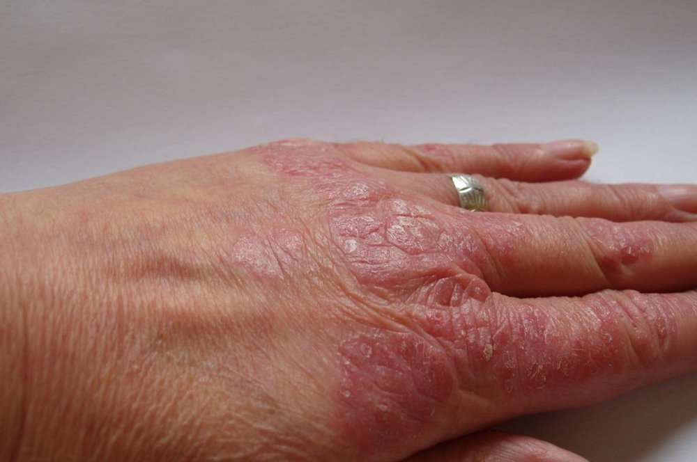 Psoriasis: Variations & How to Manage this Skin Condition