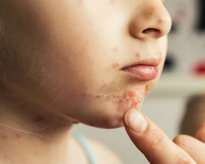 Impetigo: Spotting the Skin Condition & How to Treat
