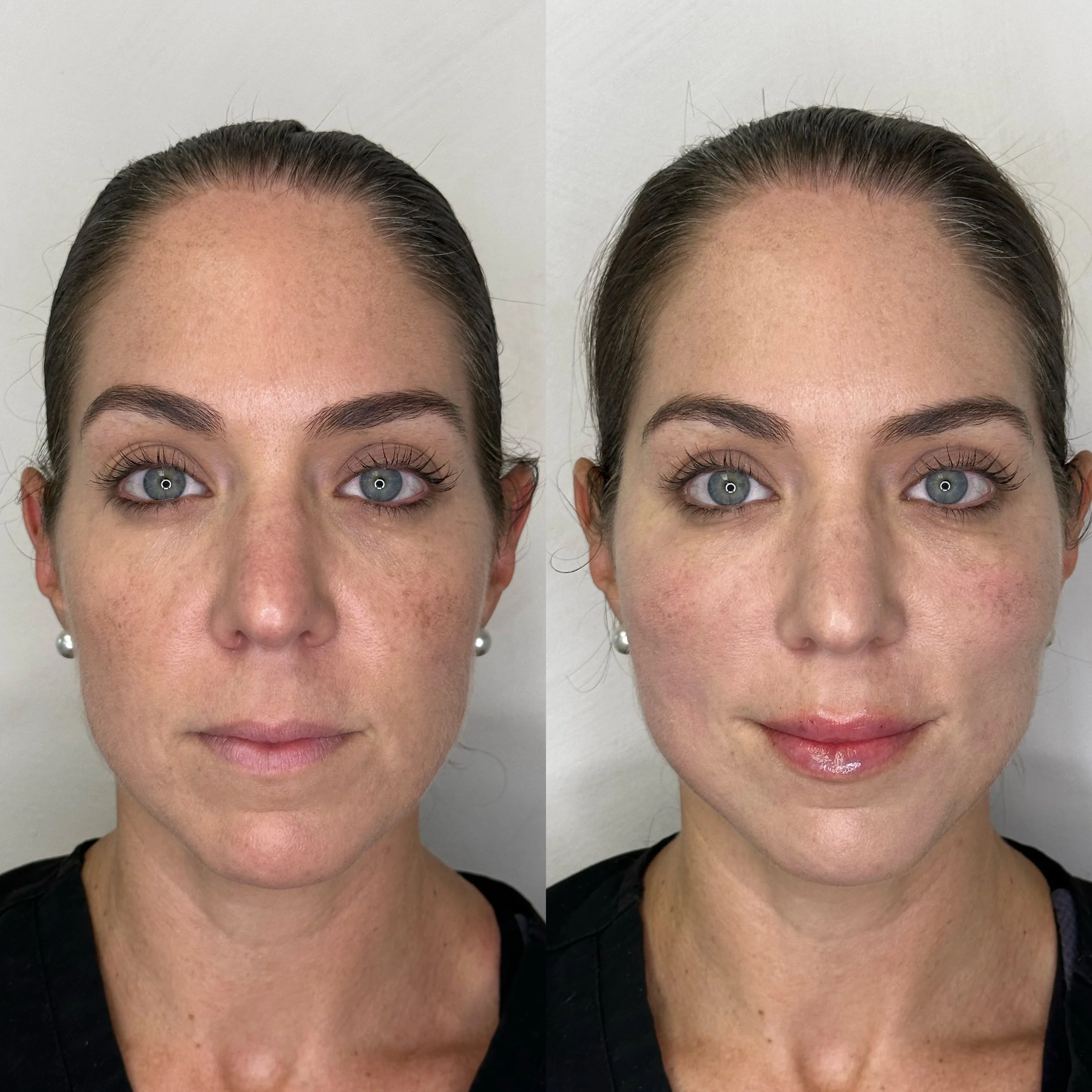 PDO Threadlift — Galore Medical