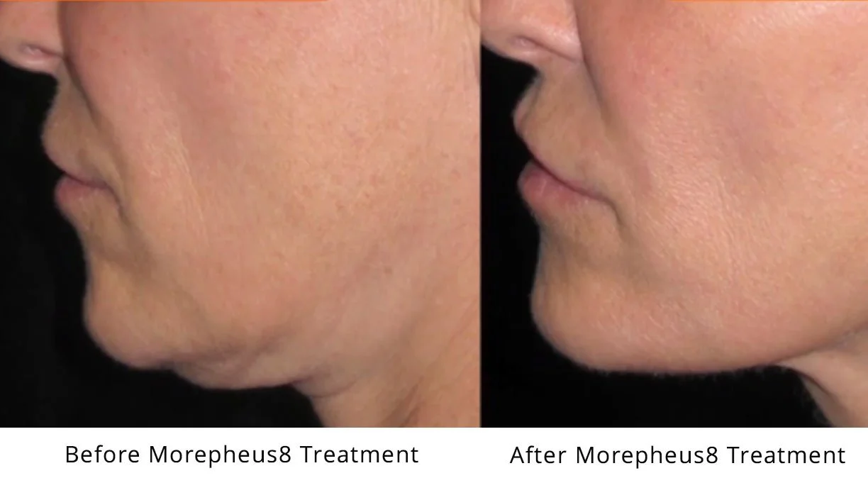 Morpheus 8 — Galore Medical