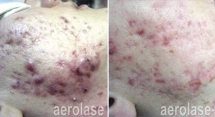 Aerolase Neo Elite — Galore Medical