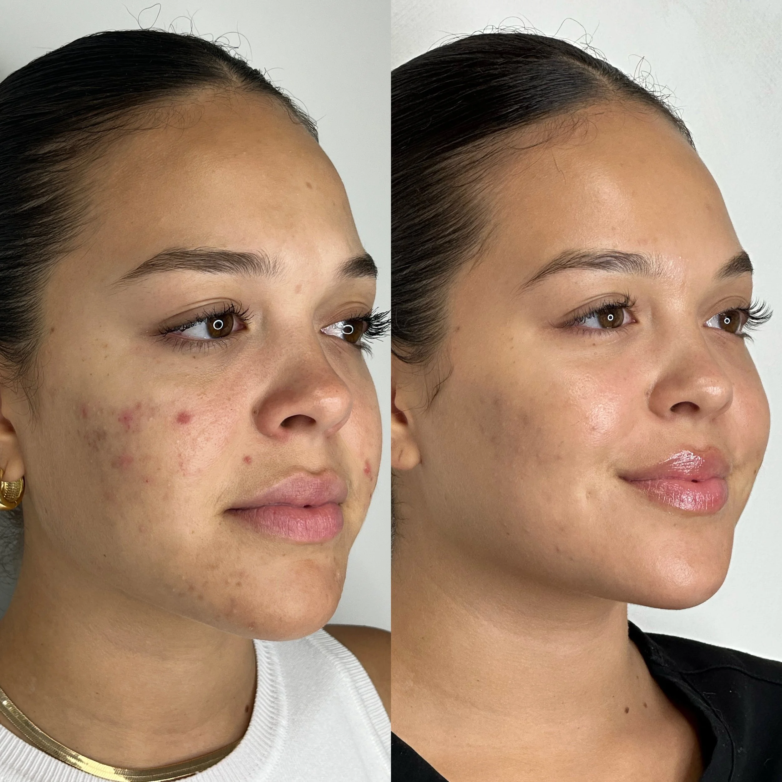 Chemical Peel — Galore Medical
