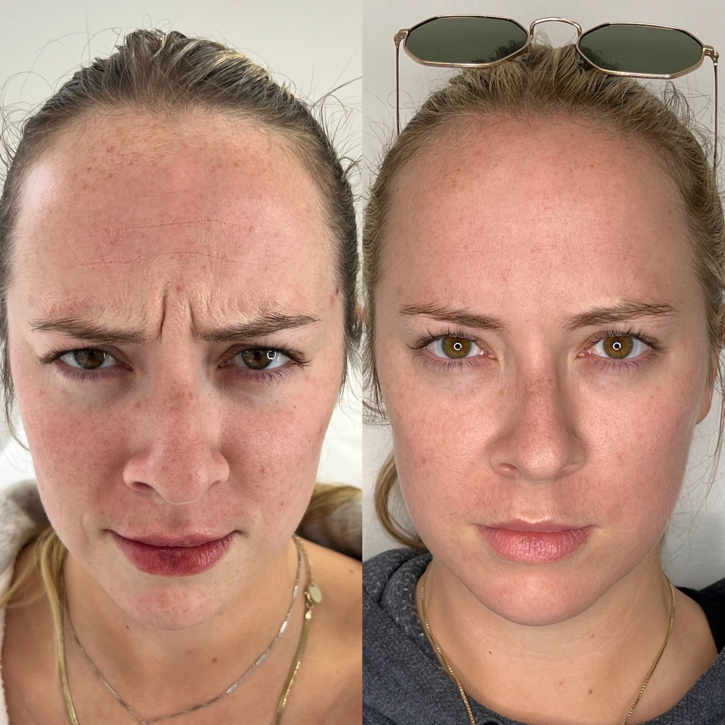 Botox — Galore Medical