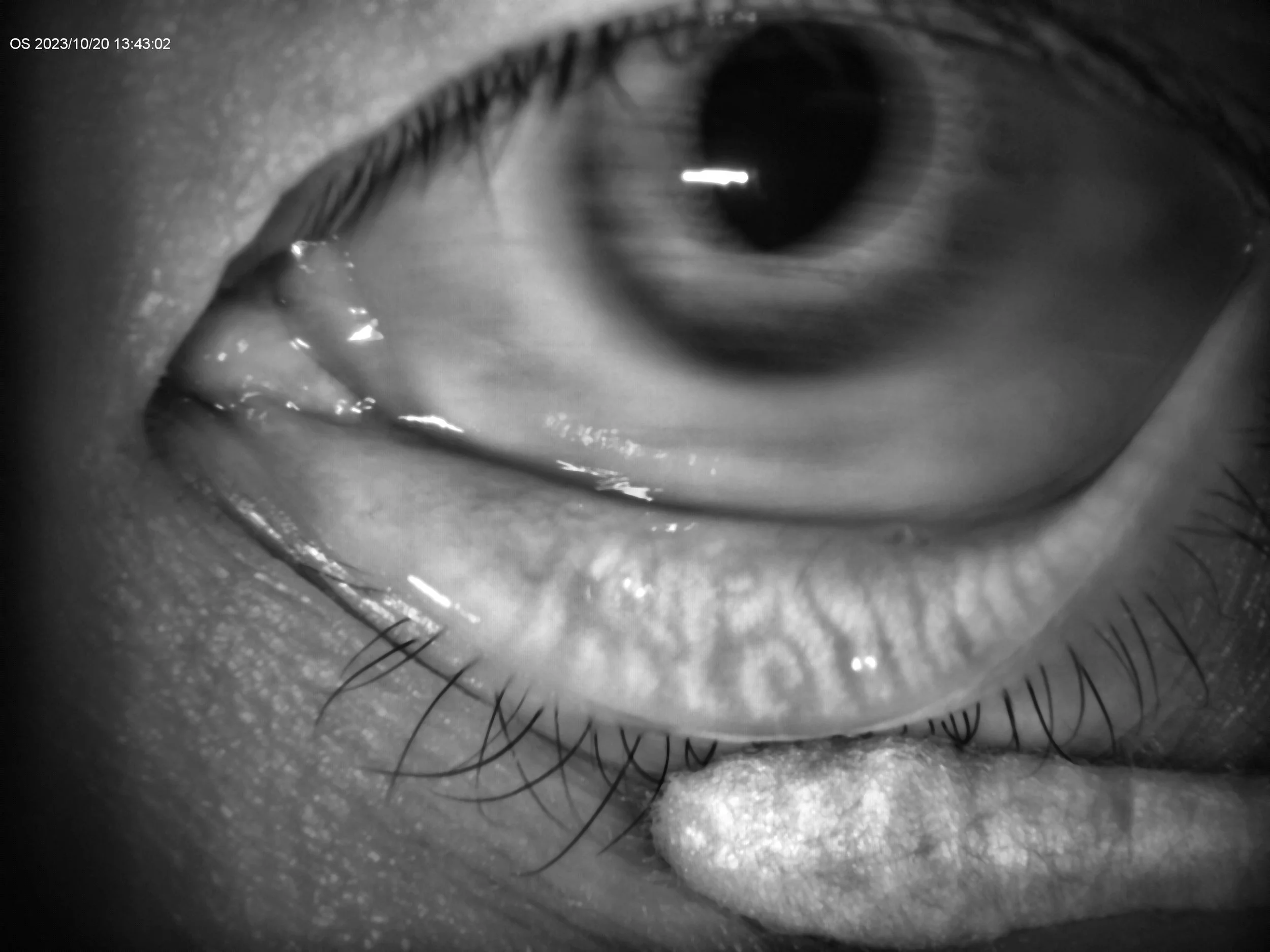 What Is MGD? — Sylvan Family Eyecare